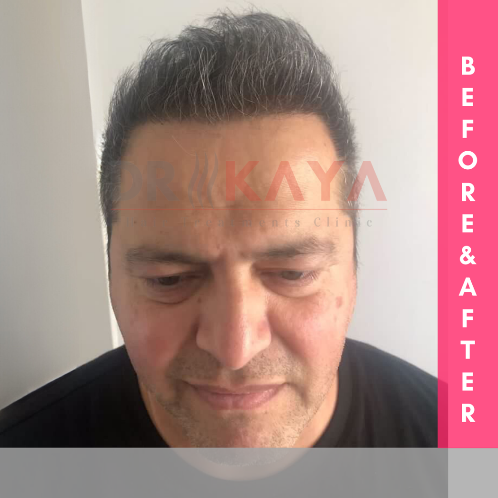 Hair Transplant in Turkey - Doctor Mahmut Alan Kaya