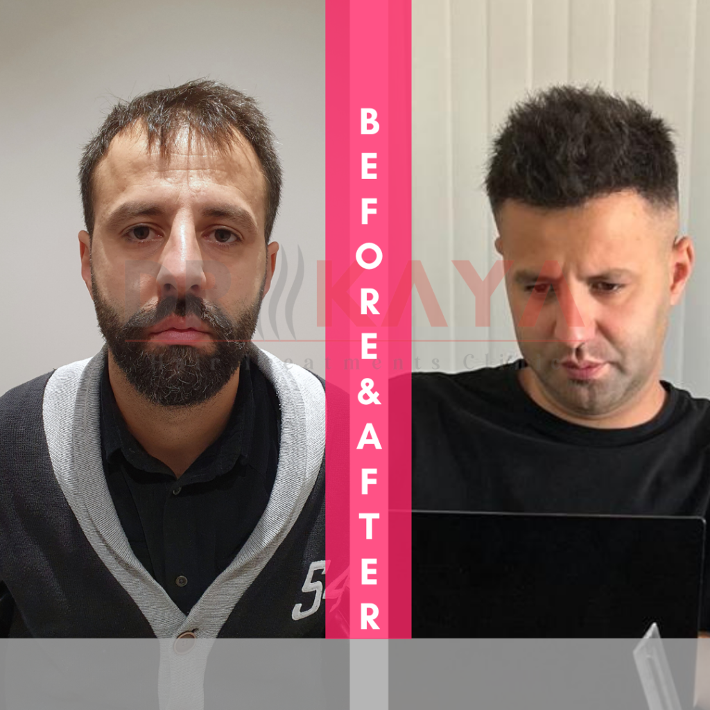 Before & After - Doctor Mahmut Alan Kaya