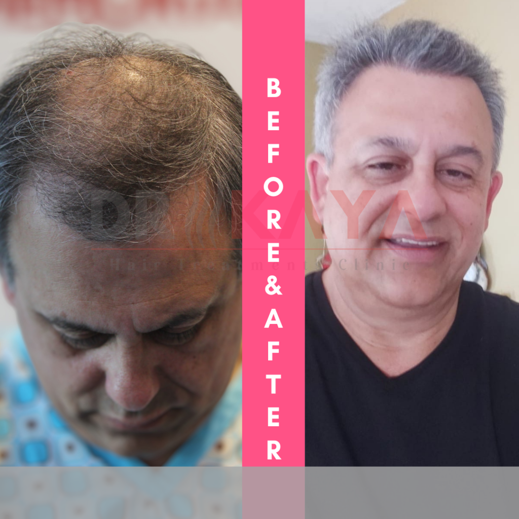 Before & After - Doctor Mahmut Alan Kaya